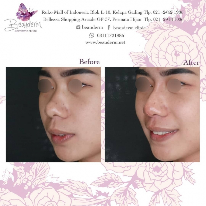 Filler Bibir Ala Jessica Iskandar Kisaran Harga di Indonesia Manfaat ...