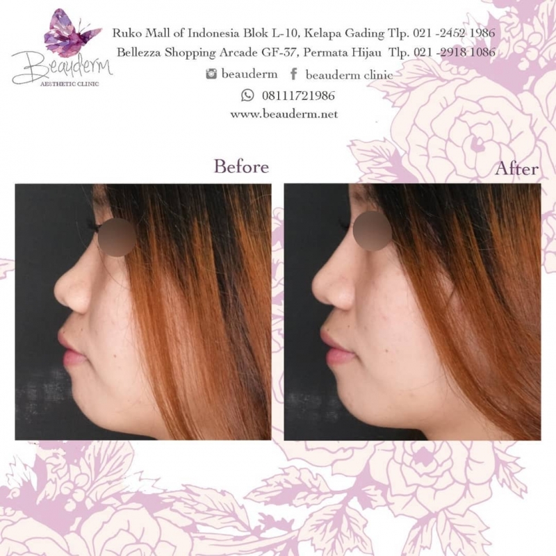 Jenis Benang yang Tepat, Perawatan Tarik Benang (Threadlift) | Jawa ...